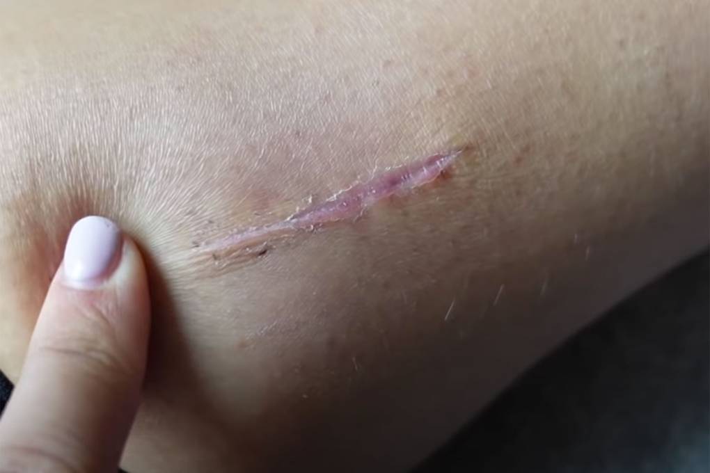 What Does A Cancerous Mole Look Like & Seeking Professional Advice ...