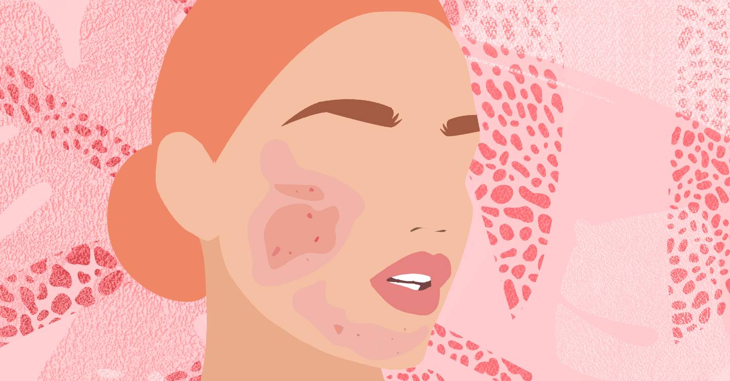 What Is Rosacea: A Dermatologist's Guide To Symptoms and Treatments | Glamour UK