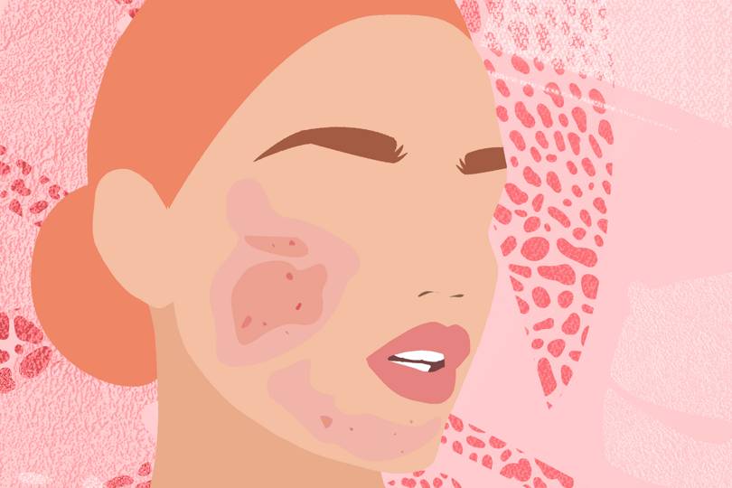 What Is Rosacea: A Dermatologist's Guide To Symptoms and Treatments ...