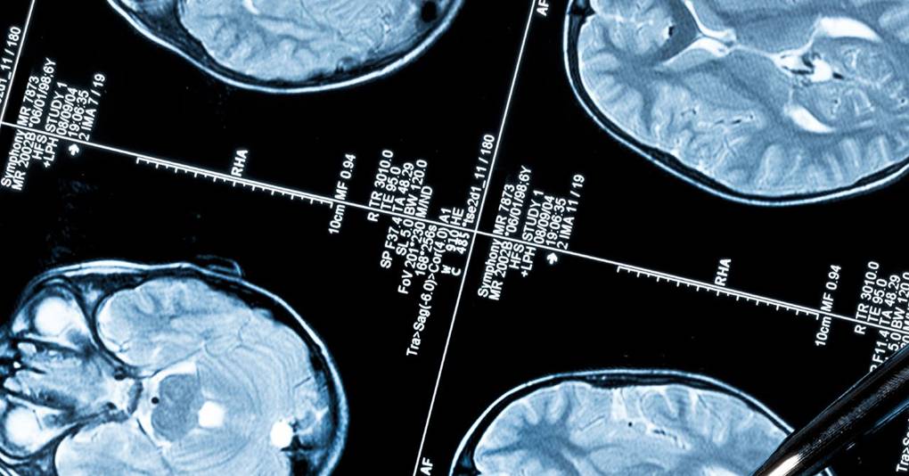 Epilepsy: personal story and facts about seizures | Glamour UK