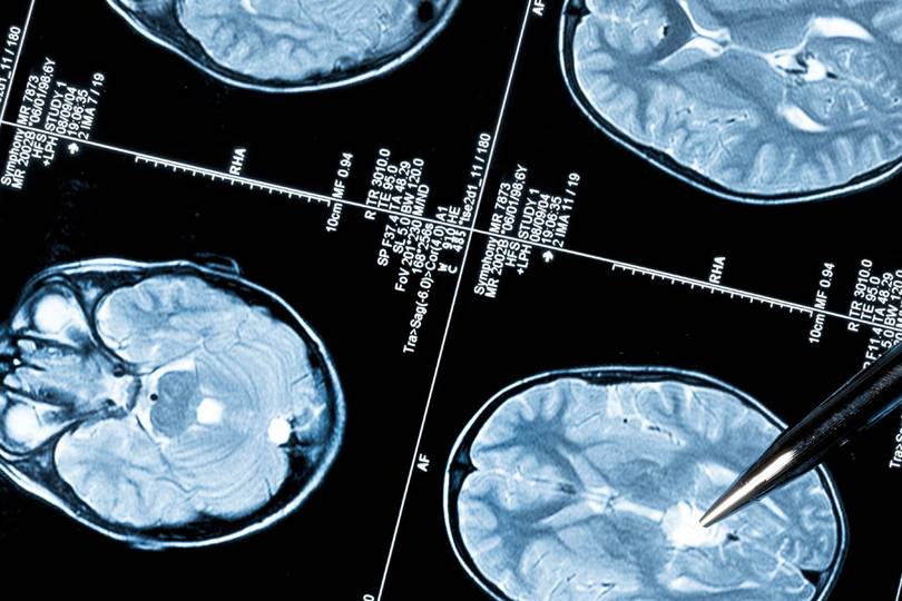 Epilepsy: personal story and facts about seizures | Glamour UK