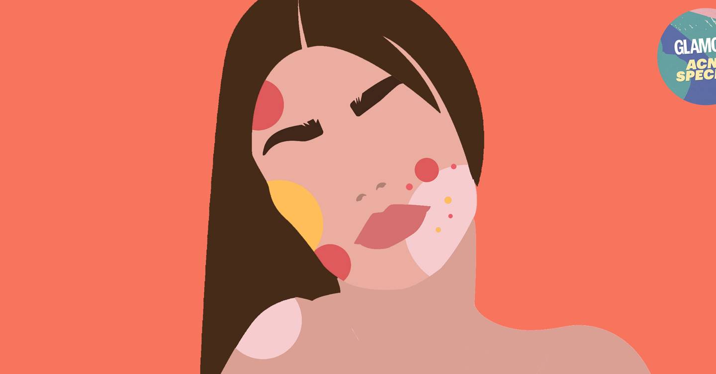 Acne Pustules: Can You Pop Them & Everything You Need To Know | Glamour UK