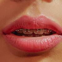 Everything You Need To Know About Getting Braces | Glamour UK