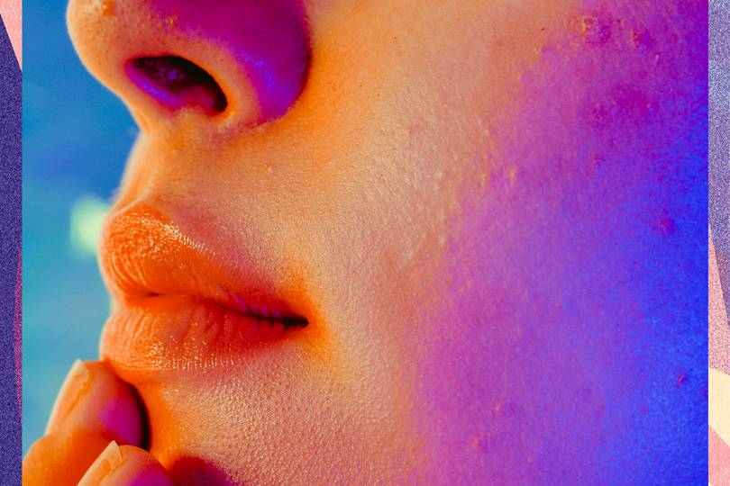 I Tried Roaccutane And This Is What Happened | Glamour UK