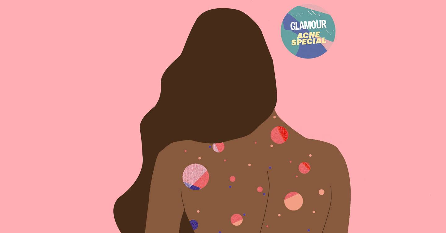 Bacne: How To Get Rid Of Back Acne | Glamour UK