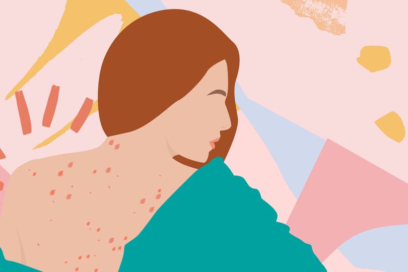 Bacne: How To Get Rid Of Back Acne | Glamour UK