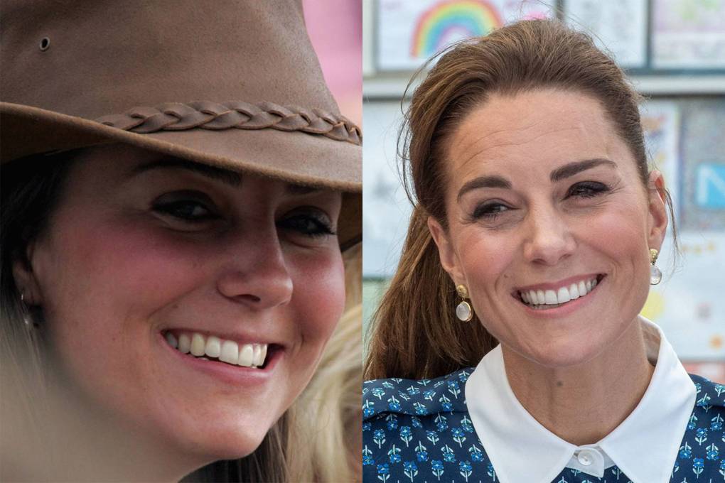 Celebrity Teeth Before & After: Dental Whitening Makeovers | Glamour UK