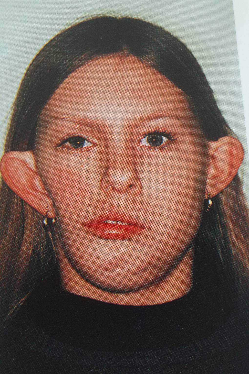 Shelley Hull On What Her Battle With Facial Disfigurement Taught Her ...