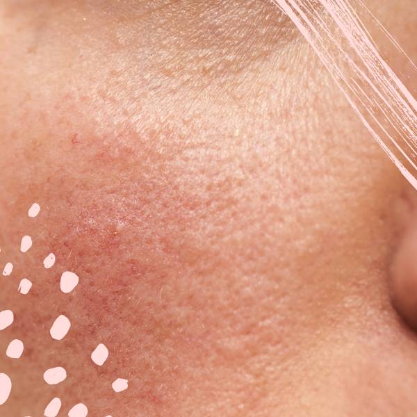 How To Treat Rosacea: What I've Learned From 5 Years With The Condition ...