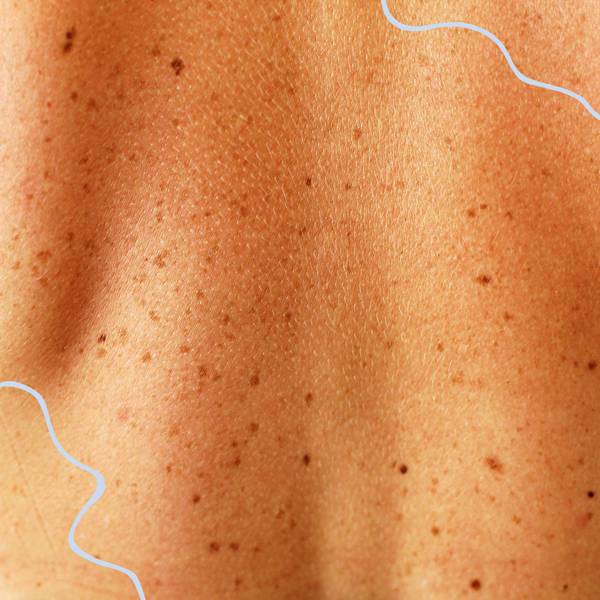 Your Fail-Safe Guide To Skin Tags From An Expert Dermatologist | Glamour UK