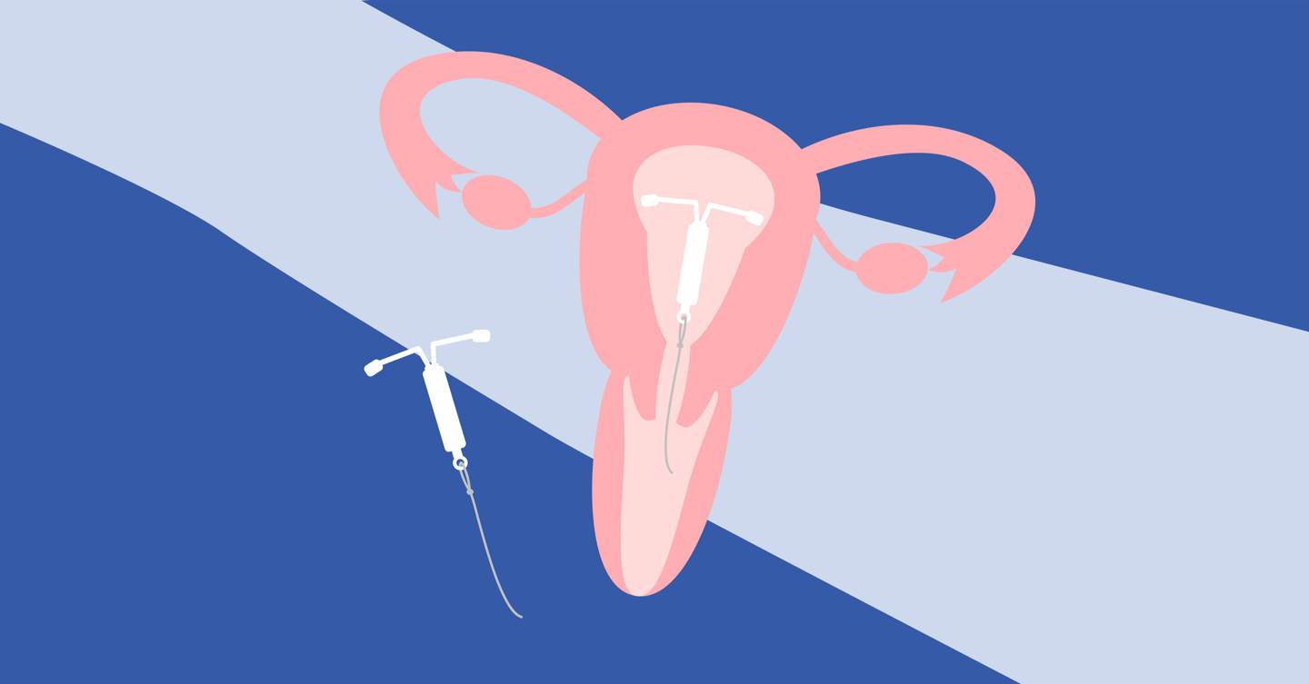 Intrauterine Device: Everything To Know About The Contraceptive Coil ...