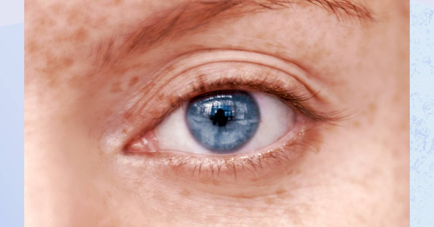 Acne Drug Minocycline Is Reportedly Turning People's Eyes and Skin Blue ...