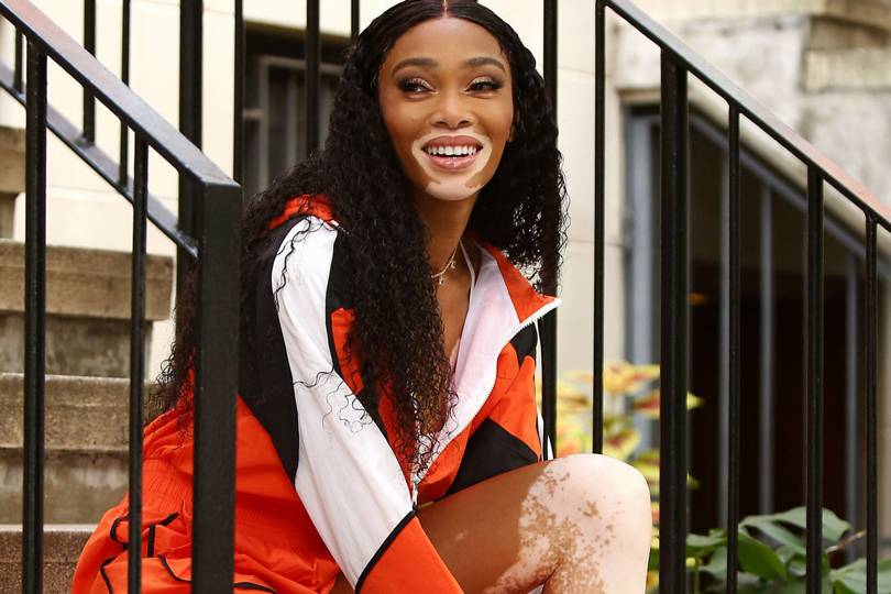 What Is Vitiligo And What Are The Causes? | Glamour UK