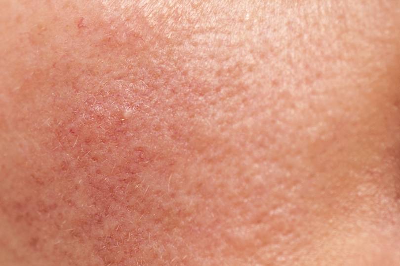 What Is Rosacea: A Dermatologist's Guide To Symptoms and Treatments ...