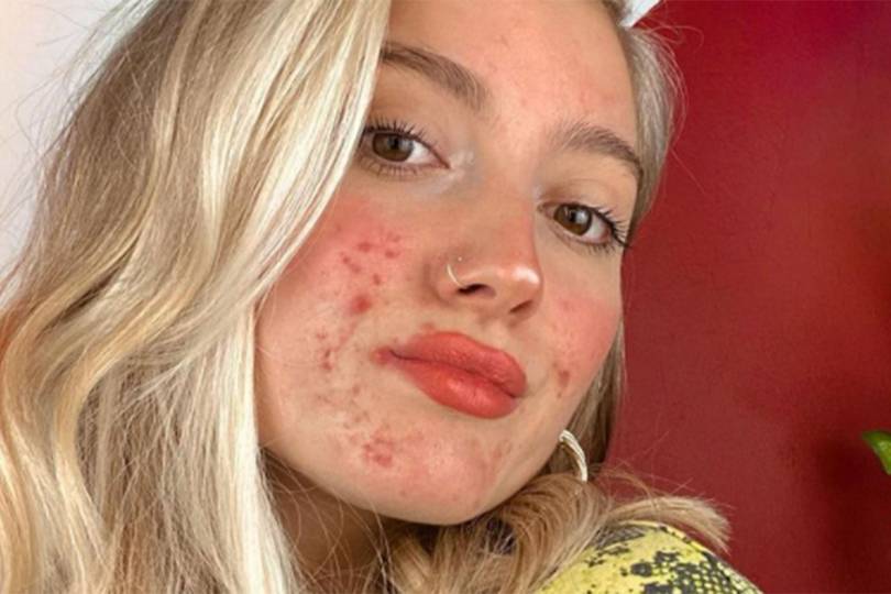 Izzie Rodgers On Embracing Her Acne On Instagram | Glamour UK