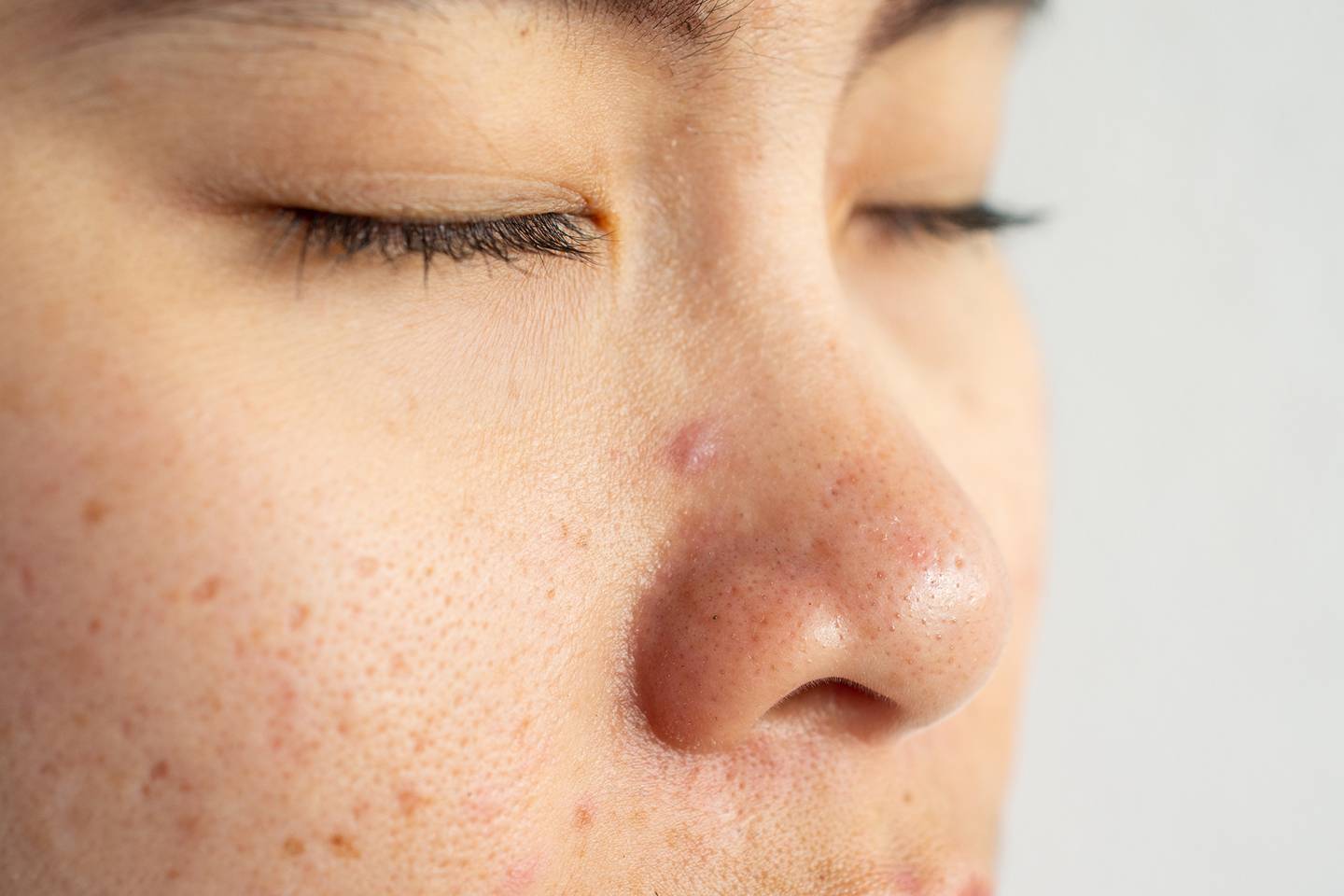 Nose Acne: A Top Dermatologist Answers Your Questions | Glamour UK