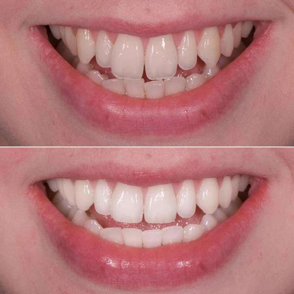 Tooth Contouring: How Cosmetic Teeth Reshaping Works And The After ...