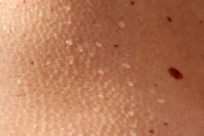 What Does A Cancerous Mole Look Like & Seeking Professional Advice ...